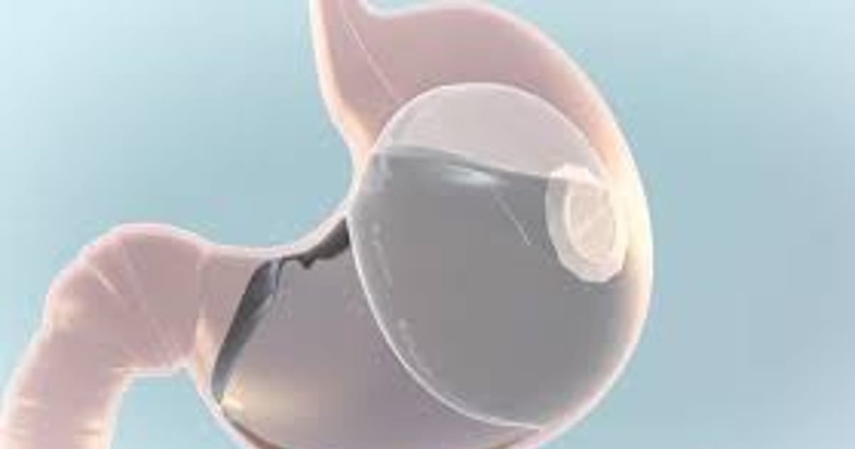 Antalya Swallowable Gastric Balloon | about.me