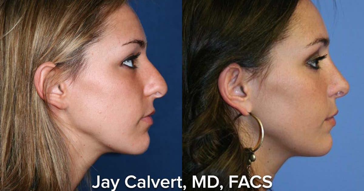 Dr. Jay Calvert - Beverly Hills, CA, Newport Beach, CA, Jay Calvert, MD ...